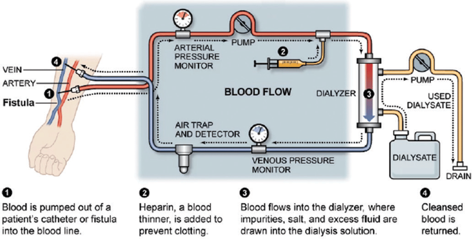 Dialysis Temperature Monitoring | Hemodialysis