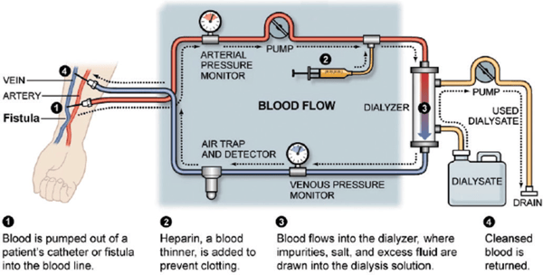 Temperature Monitoring in Hemodialysis - Application Spotlight