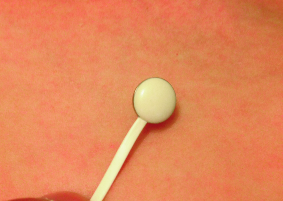 Neonatal Temperature Monitoring | Skin Surface